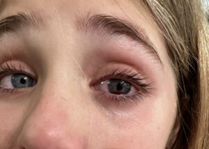 Nerf Gun Eye Injury: Child Shot in Eye with Nerf Gun? What to Do!