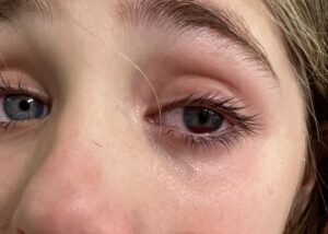 Nerf Gun Eye Injury: Child Shot in Eye with Nerf Gun? What to Do!