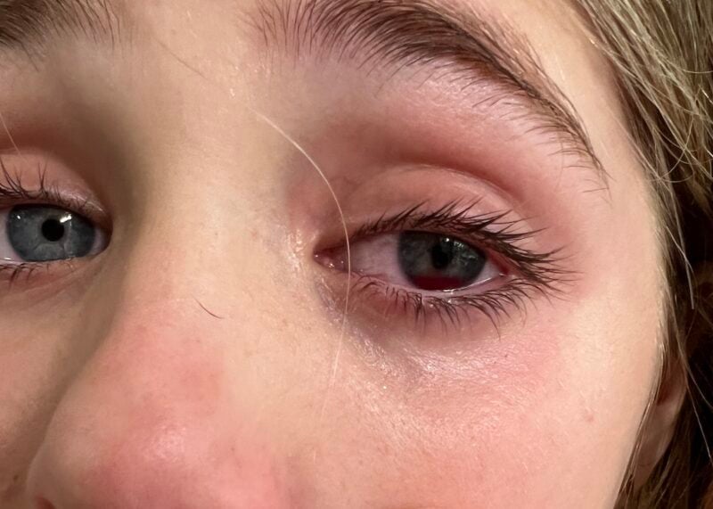 Nerf Gun Eye Injury: Child Shot in Eye with Nerf Gun? What to Do!