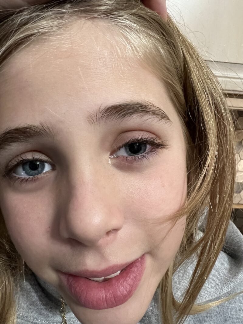 Nerf Gun Eye Injury: Child Shot in Eye with Nerf Gun? What to Do!